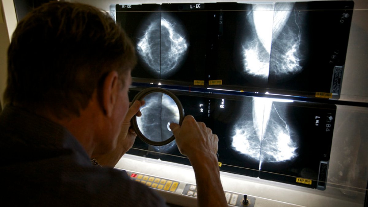 More Breast Cancer Patients Can Forgo Mastectomies and Choose Smaller ...