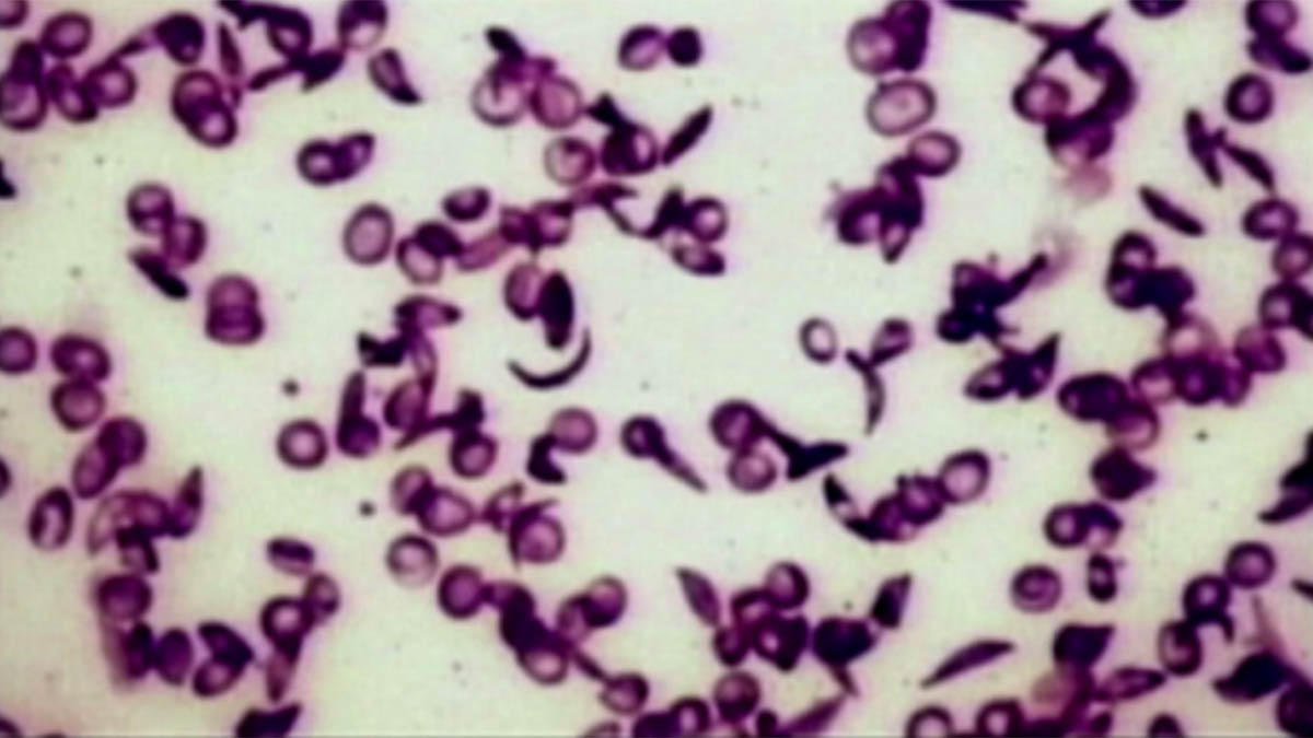 FDA approves groundbreaking treatments for sickle cell disease – NBC Boston