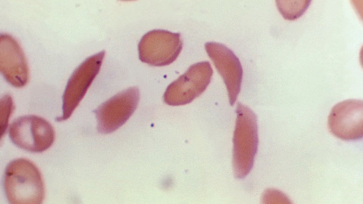 FDA approves first CRISPR-based treatment for sickle cell disease – NBC ...