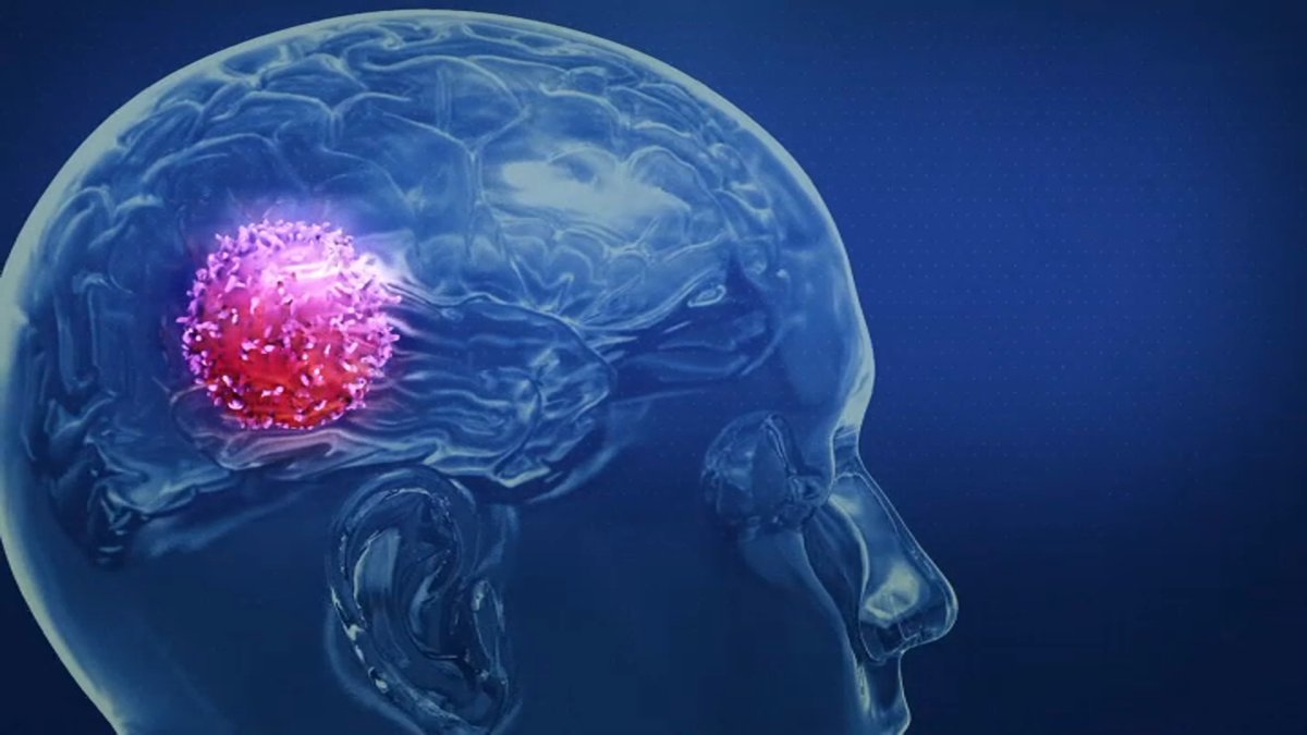 MGH glioblastoma brain cancer treatment – NBC Boston