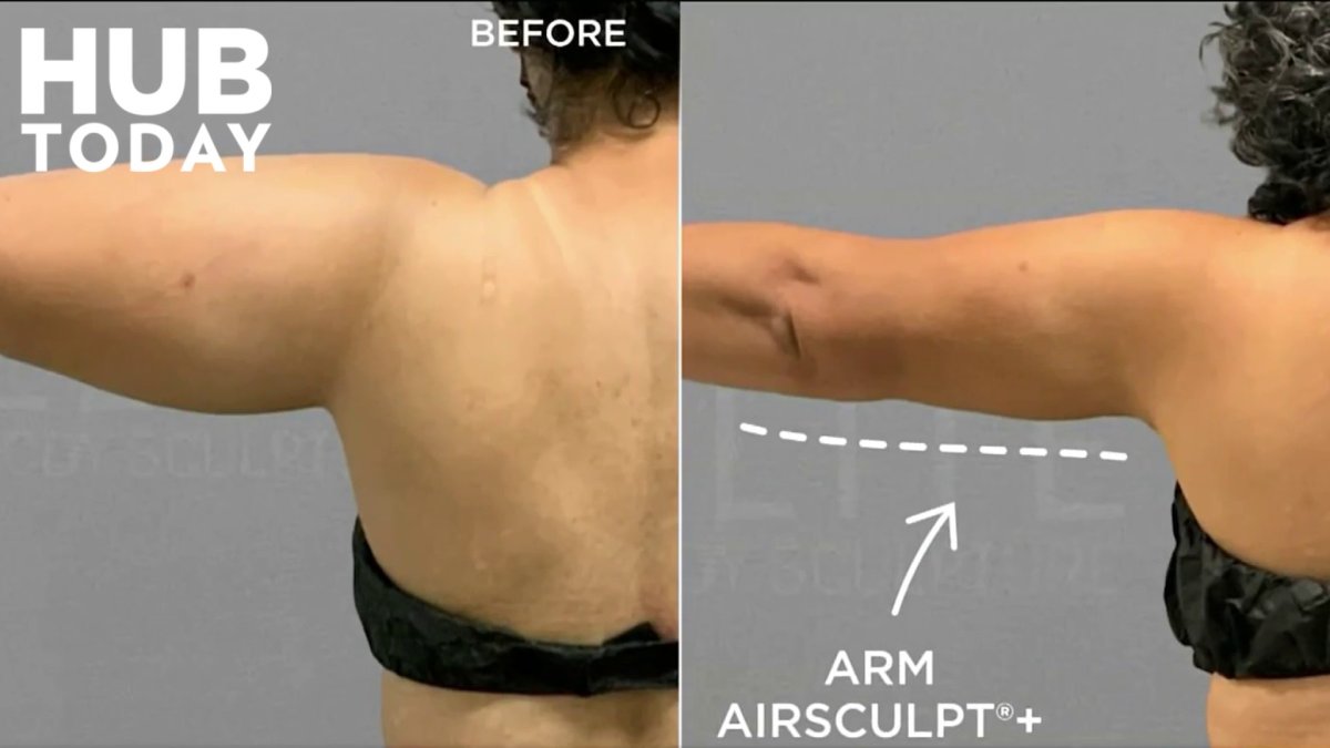 Boston’s new non-invasive body fat removal procedure – NBC Boston