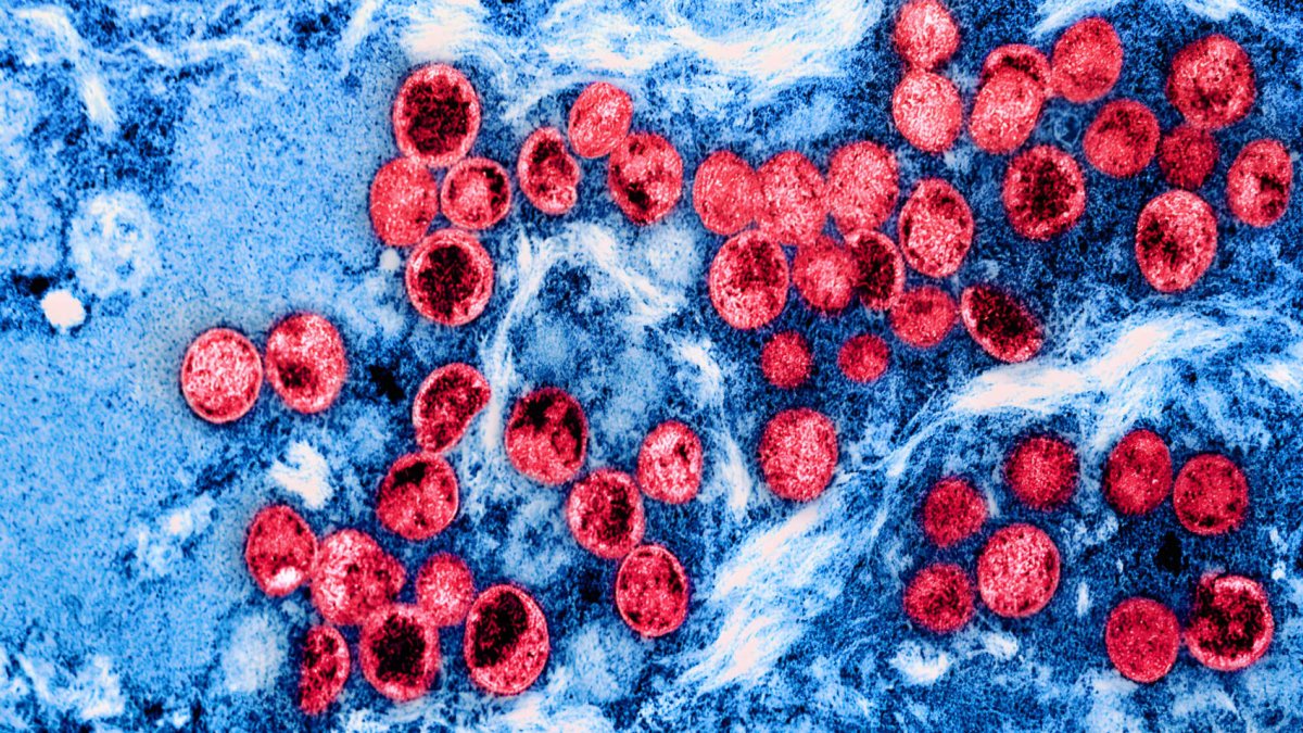 3rd US mpox case reported in NH: What we know – NBC Boston
