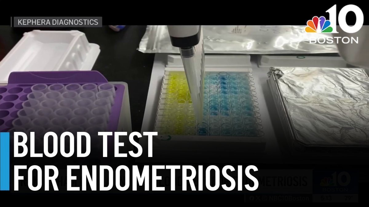 Framingham lab launches blood test for endometriosis – NBC Boston