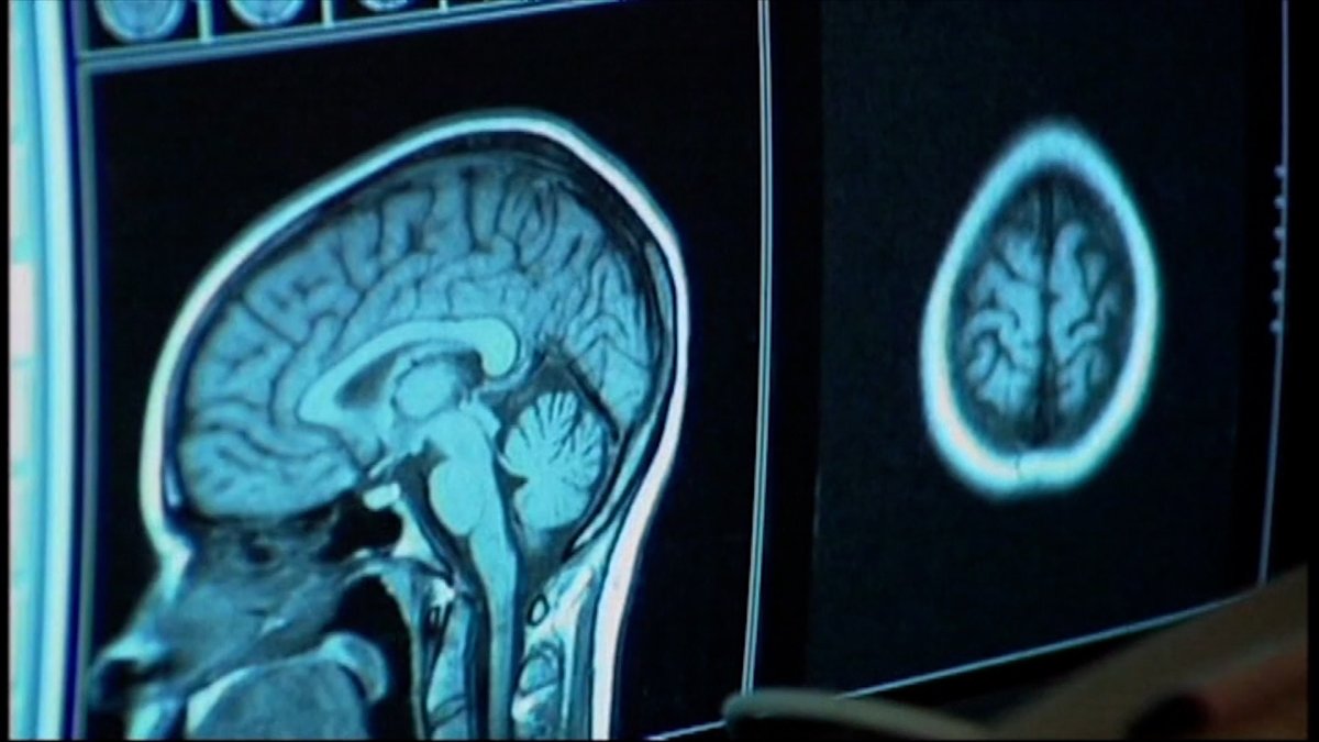What is a concussion? Watch how CTE affects the brain – NBC Boston